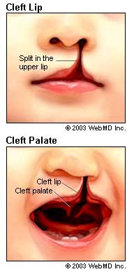 Cleft Lip in the Middle Ages | THE WRITER-LY WORLD OF ANDREA CEFALO